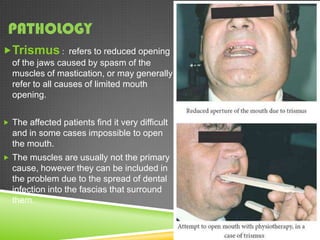 Muscles of mastication | PPTX