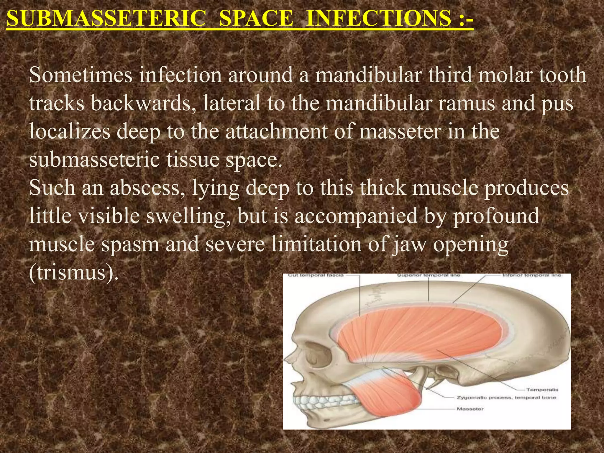 Muscles of mastication.ppt