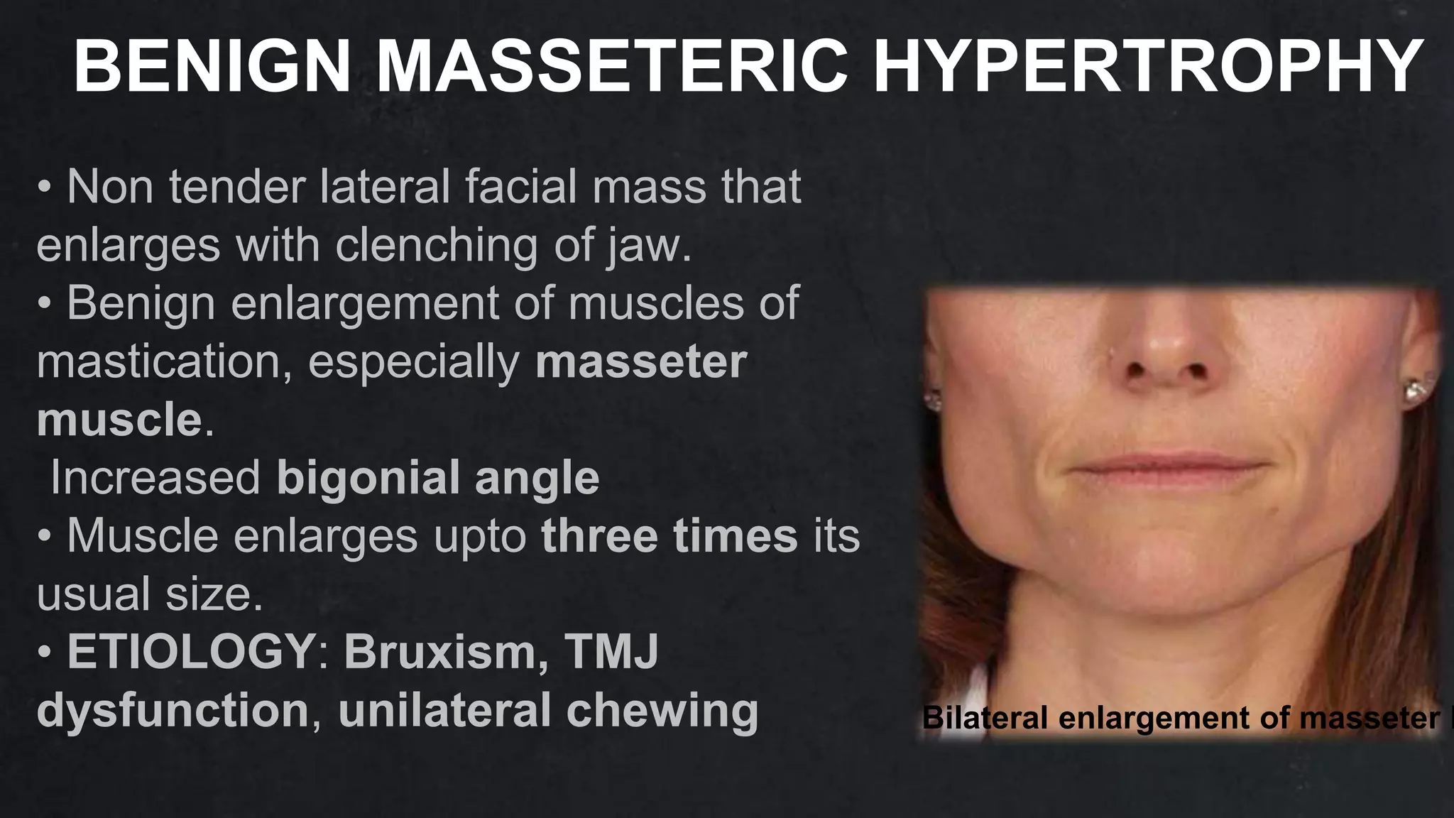 Muscles of mastication | PPTX