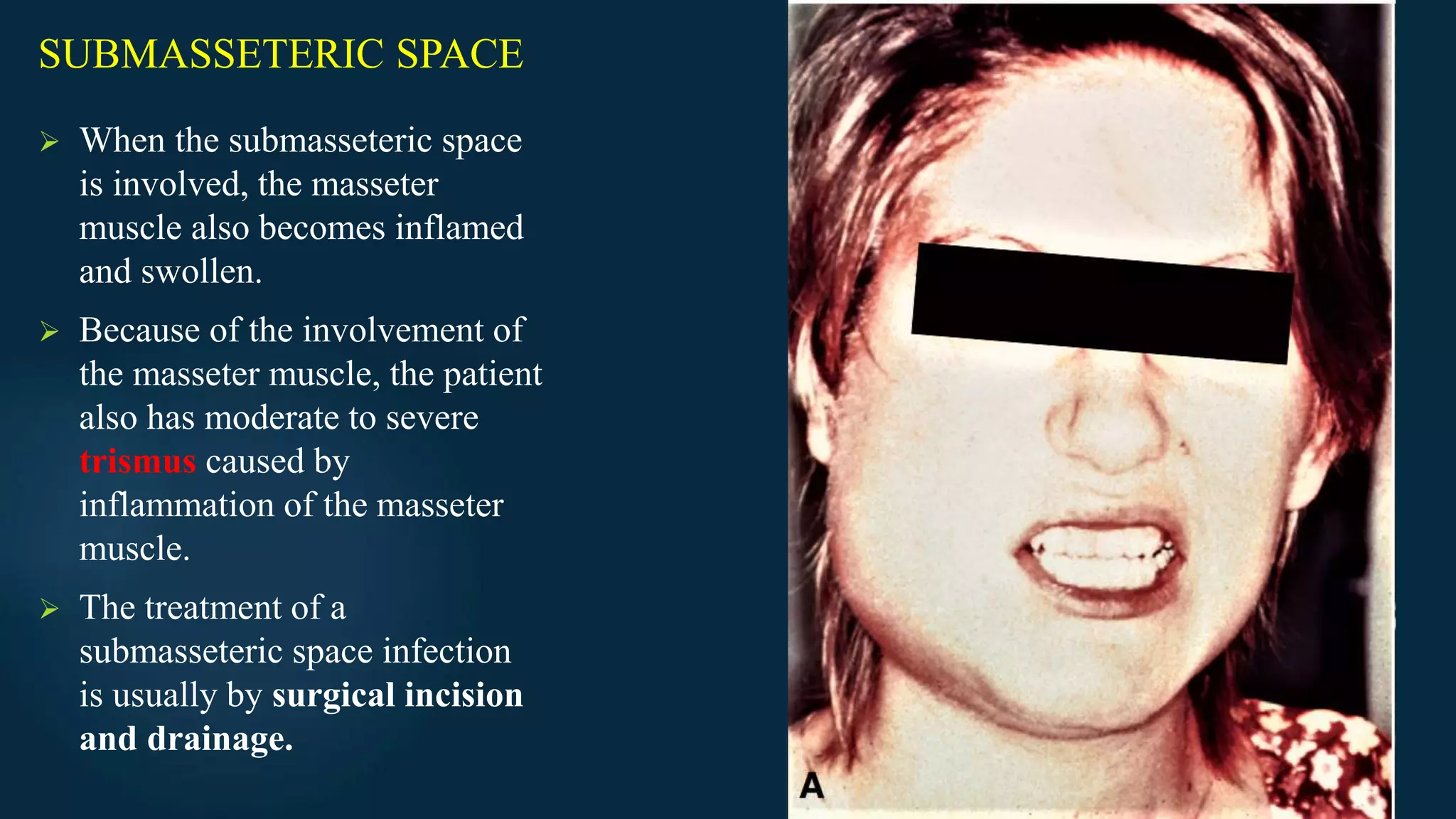 Muscles of Mastication.pptx