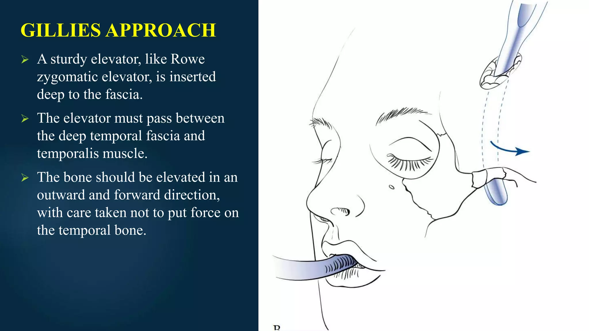 Muscles of Mastication.pptx