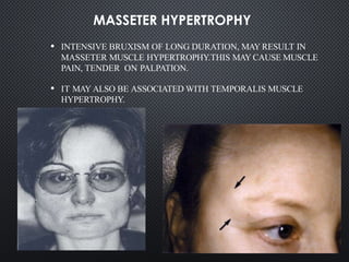 MUSCLES OF MASTICATION .pptx presentation | PPTX