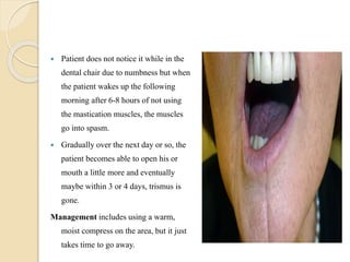 Muscles of mastication and its physiology | PPTX