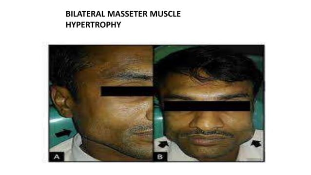 MUSCLES OF MASTICATION and chewing cycle | PPTX | Death, Injury, or ...