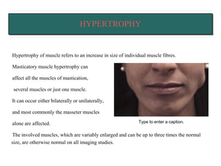 Muscles of mastication powerpoint | PPTX