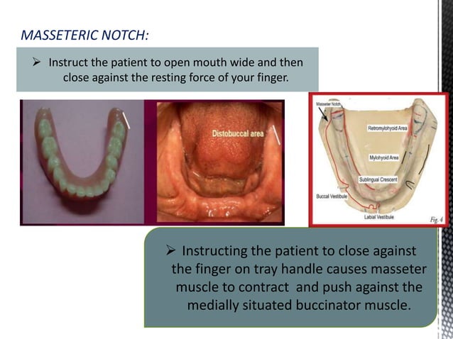 Muscles surrounding Complete Denture | PPTX