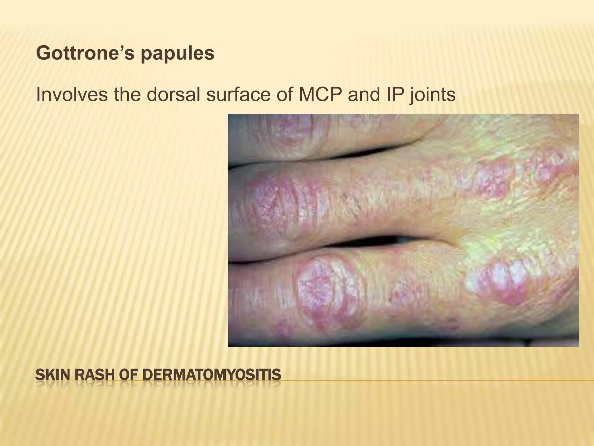 Muscle weakness & rash (Dermatomyositis) | PPTX