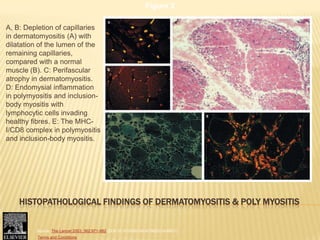 Muscle weakness & rash (Dermatomyositis) | PPTX