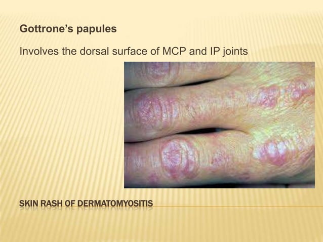 Muscle weakness & rash (Dermatomyositis) | PPTX | Skin and Dermatology ...