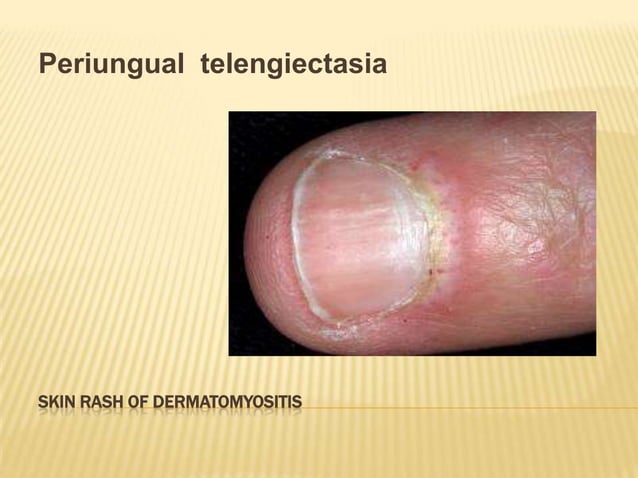 Muscle weakness & rash (Dermatomyositis) | PPTX | Skin and Dermatology ...