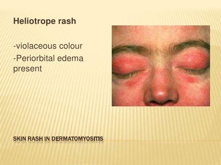 Muscle weakness & rash (Dermatomyositis)