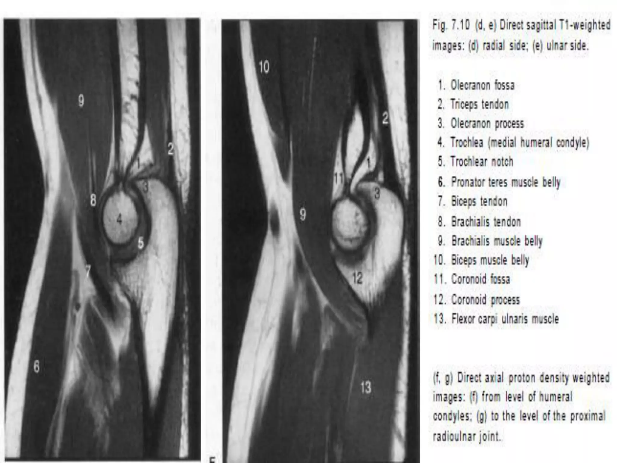 Muscular anatomy of upper limb, MRI Anatomy | PDF