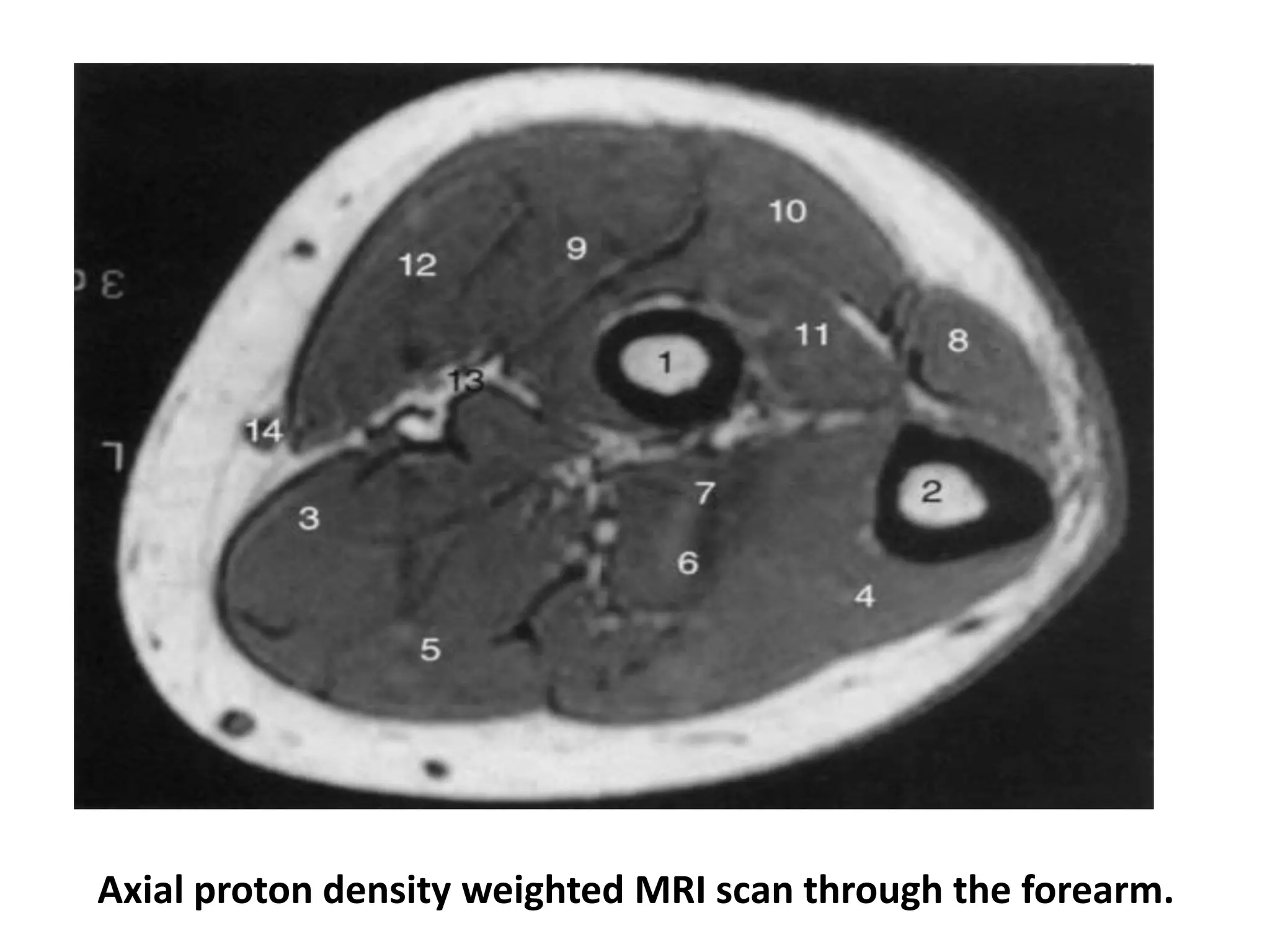 Muscular anatomy of upper limb, MRI Anatomy | PDF