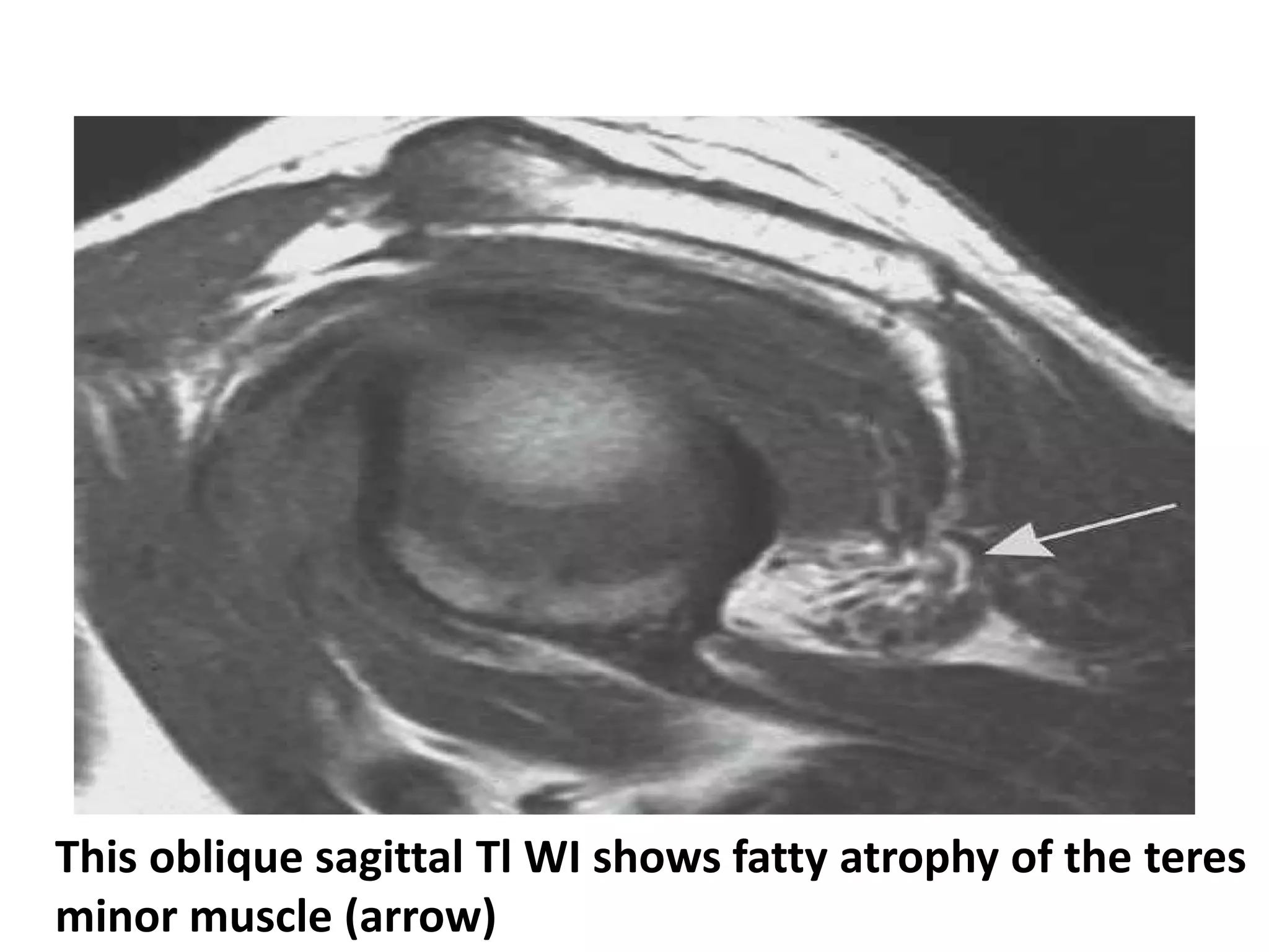 Muscular anatomy of upper limb, MRI Anatomy | PDF