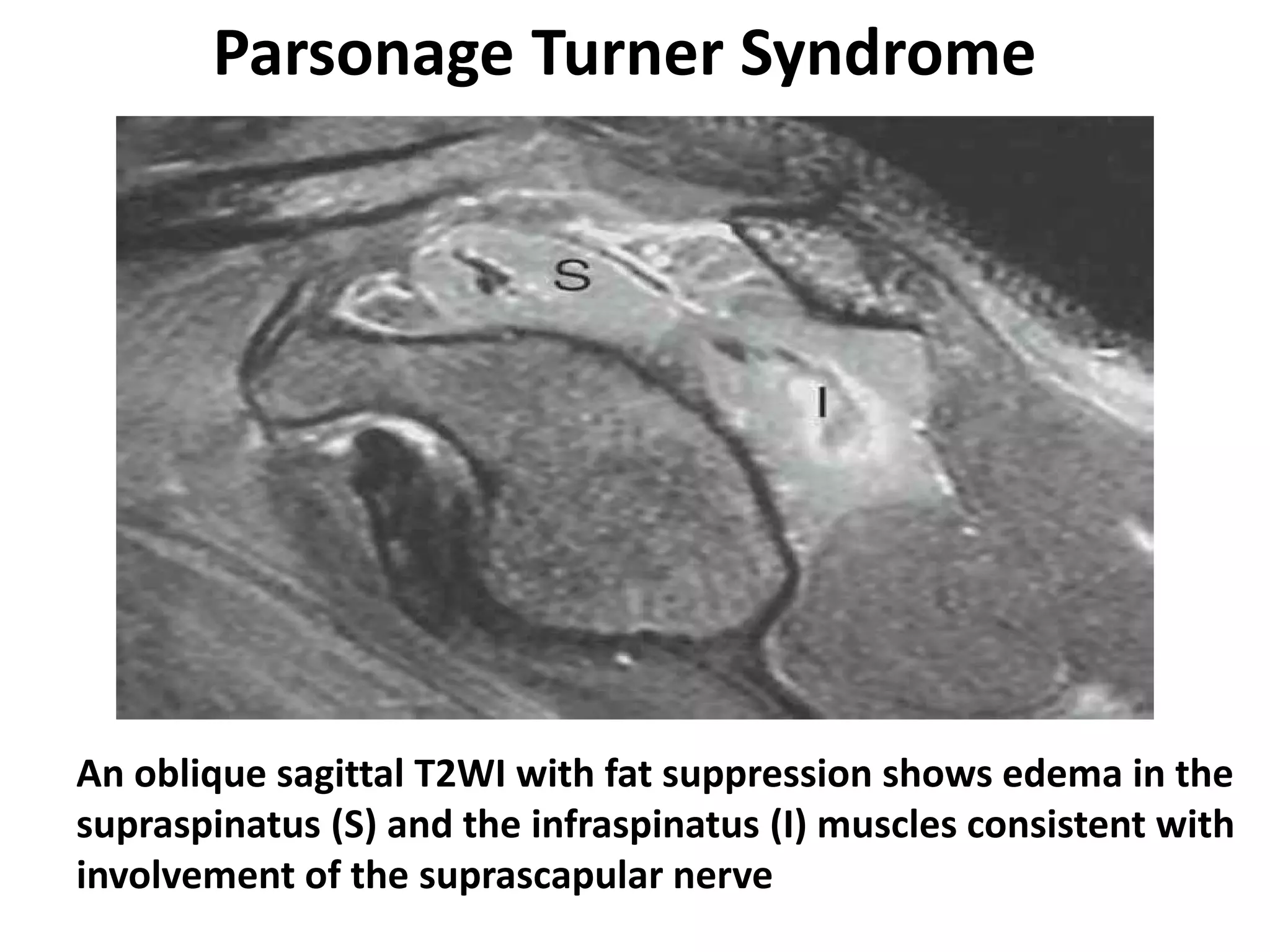 Muscular anatomy of upper limb, MRI Anatomy | PDF