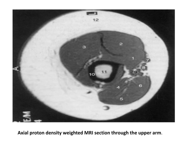 Muscular anatomy of upper limb, MRI Anatomy | PDF
