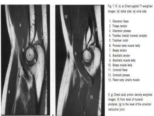Muscular anatomy of upper limb, MRI Anatomy | PDF