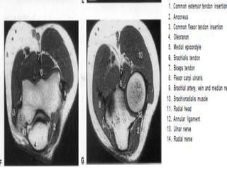 Muscular anatomy of upper limb, MRI Anatomy | PDF