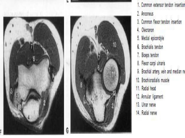 Muscular anatomy of upper limb, MRI Anatomy | PDF