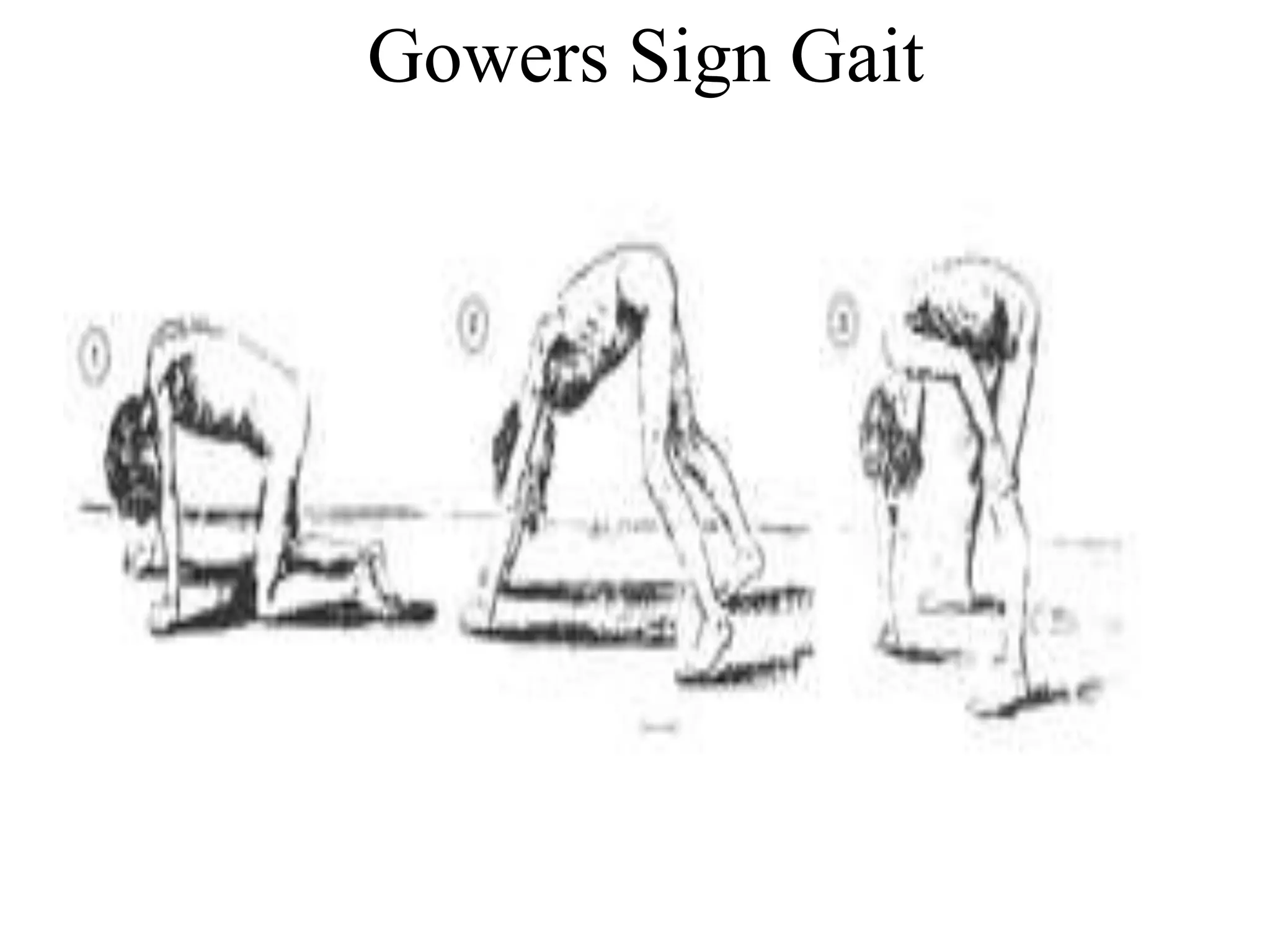 Muscular Dystrophies | PPTX
