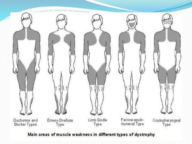 Muscular dystrophies