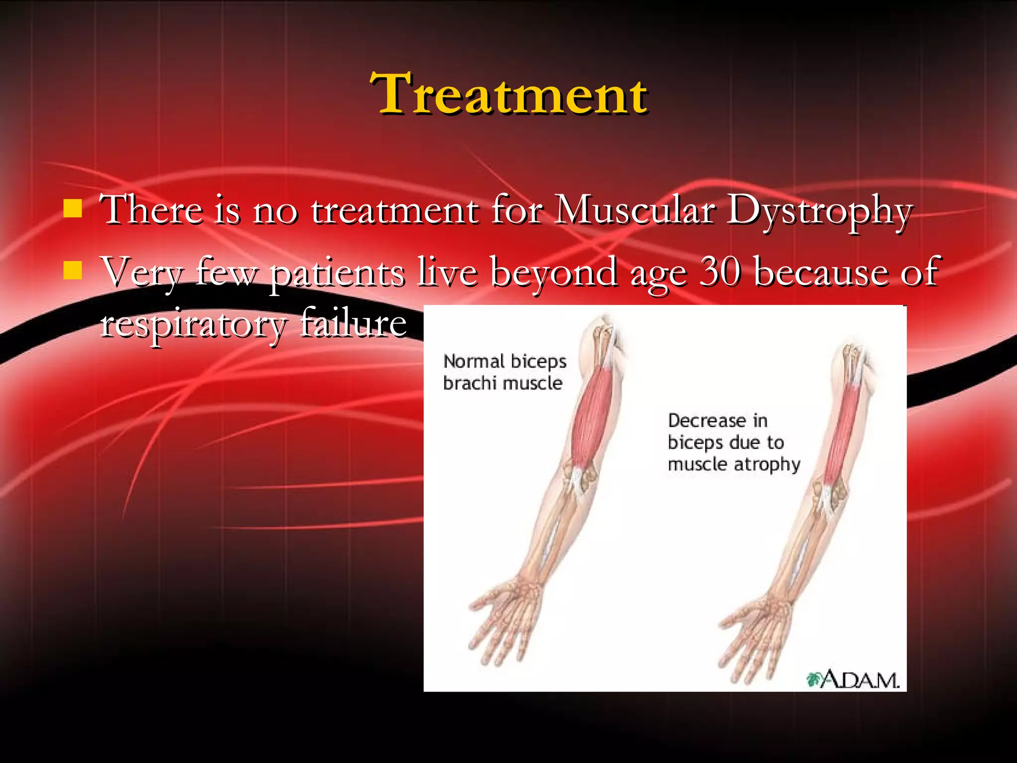 Muscular dystrophy | PPT