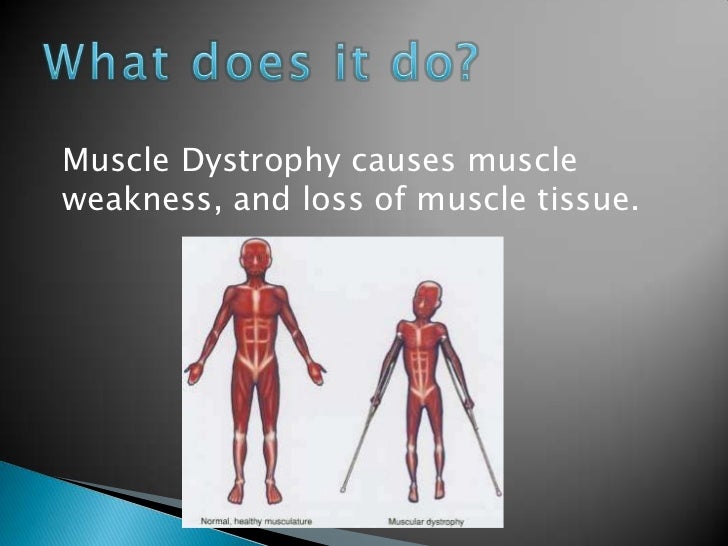 Muscular dystrophy