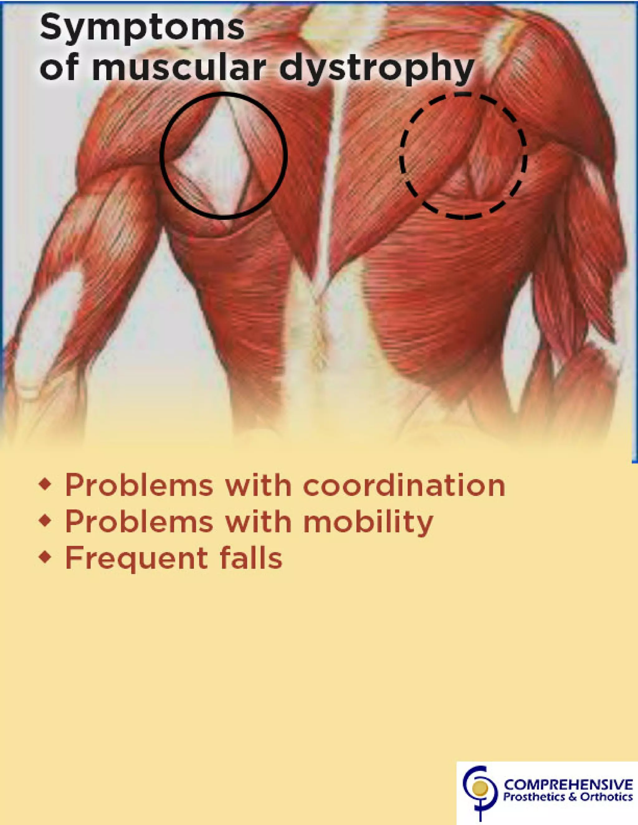 Muscular Dystrophy | PDF