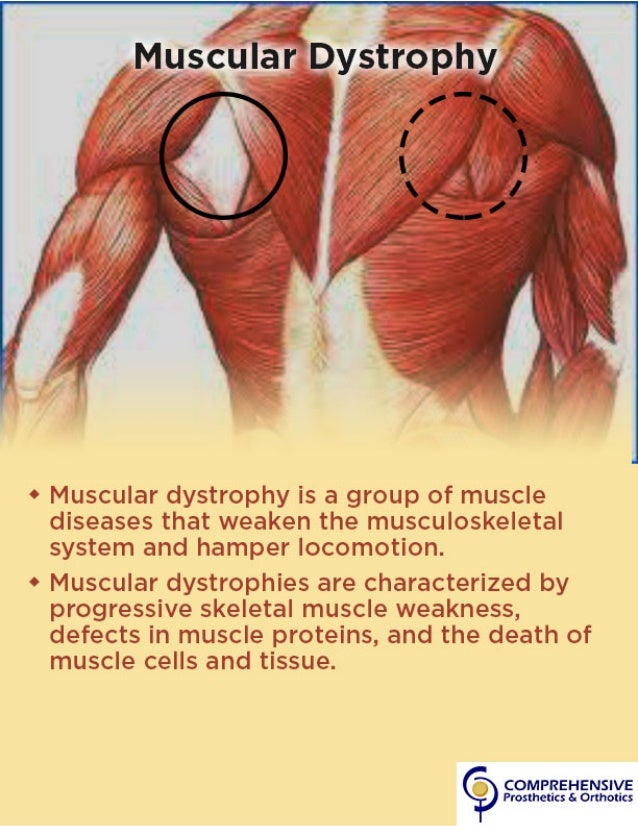 Muscular Dystrophy