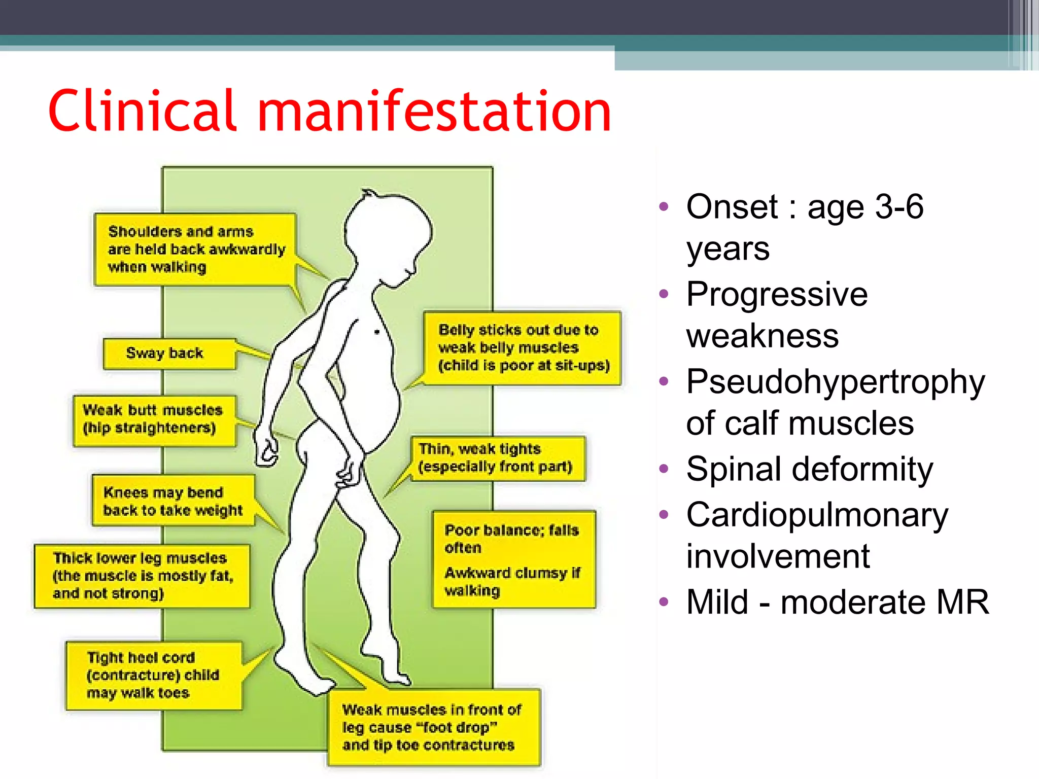 Muscular dystrophy | PPT