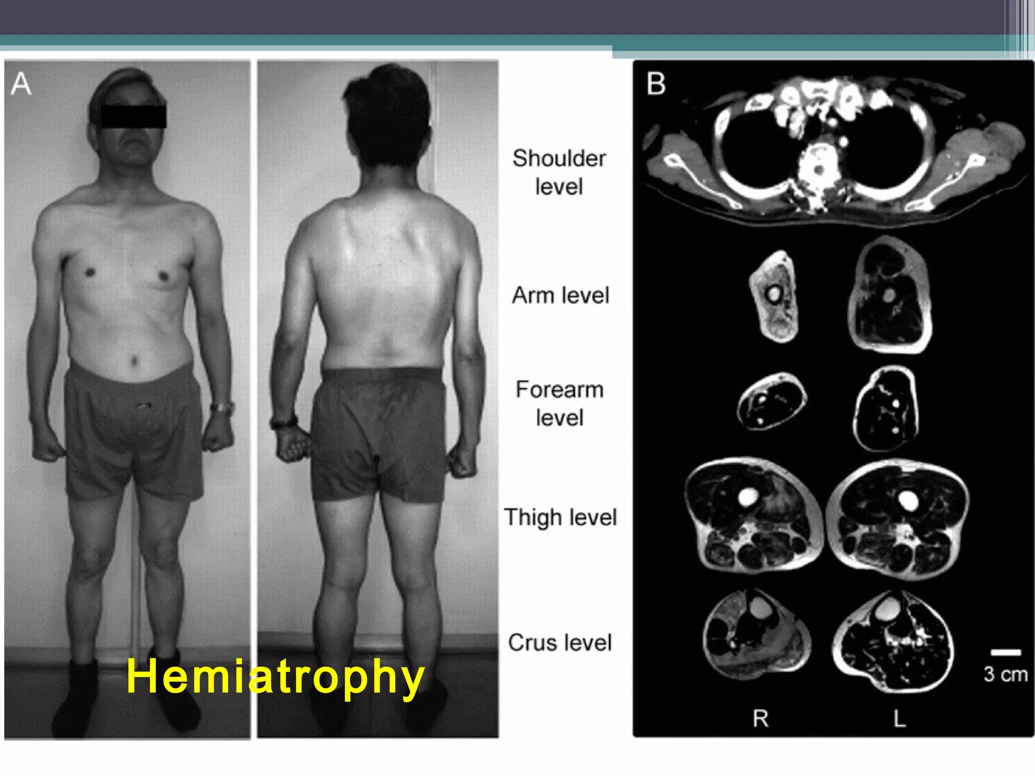 Muscular dystrophy | PPT