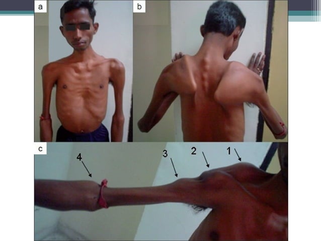 Muscular dystrophy | PPT | Bone and Joint Conditions | Diseases and ...