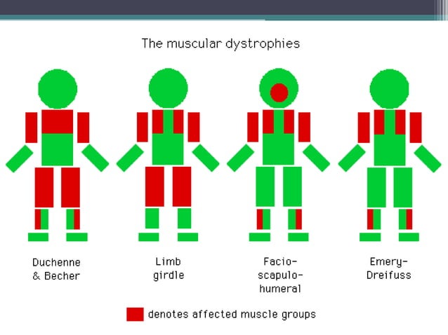 Muscular dystrophy | PPT