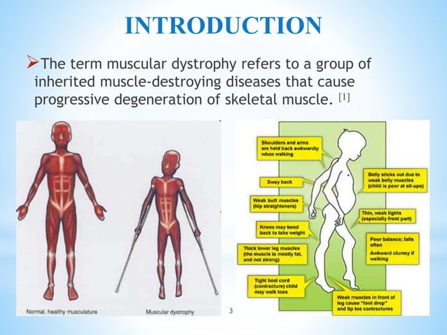 Muscular dystrophy | PPTX | Physical Therapy | Wellness