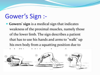 Gowers Sign