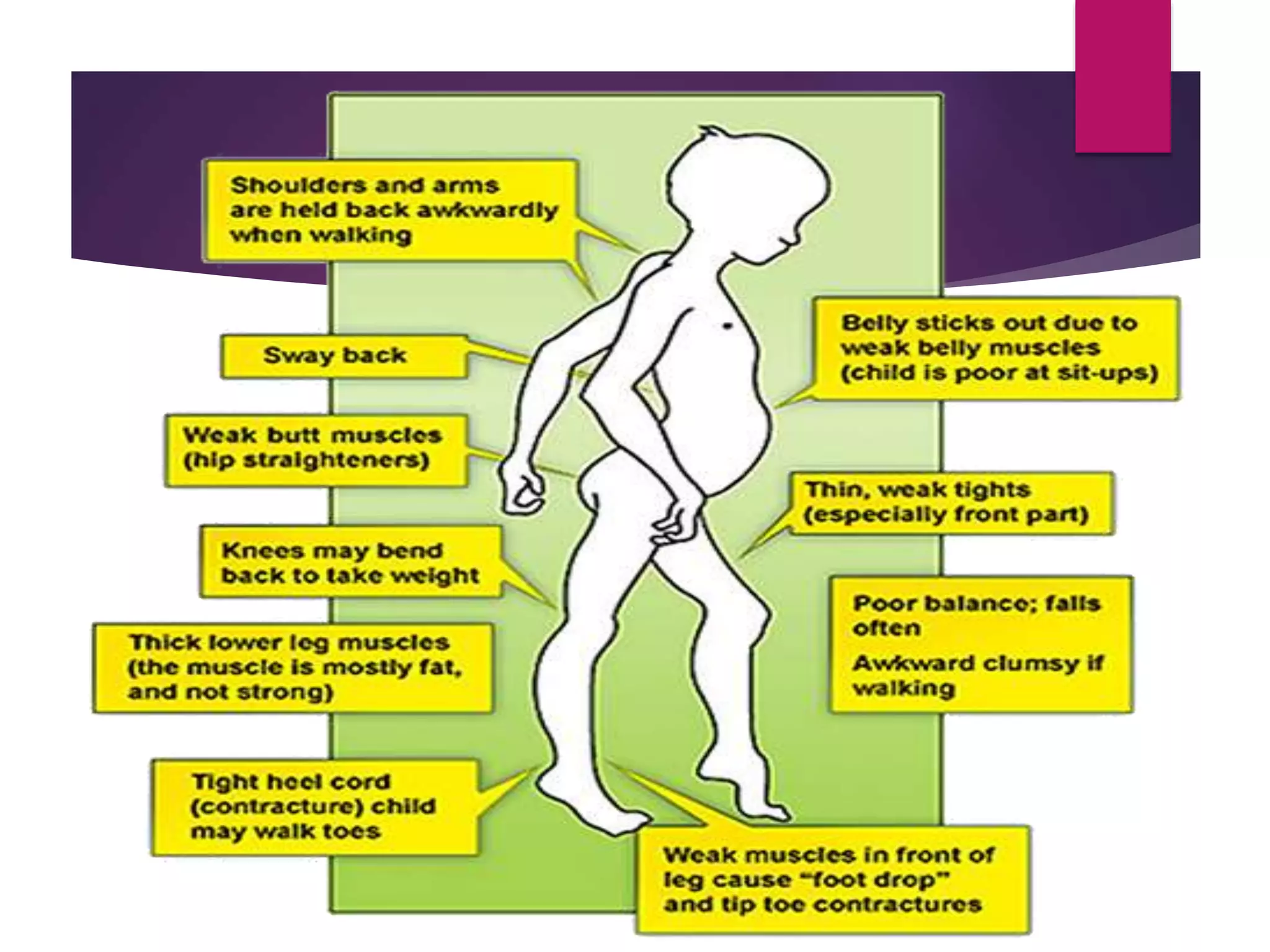 Muscular dystrophy | PPTX