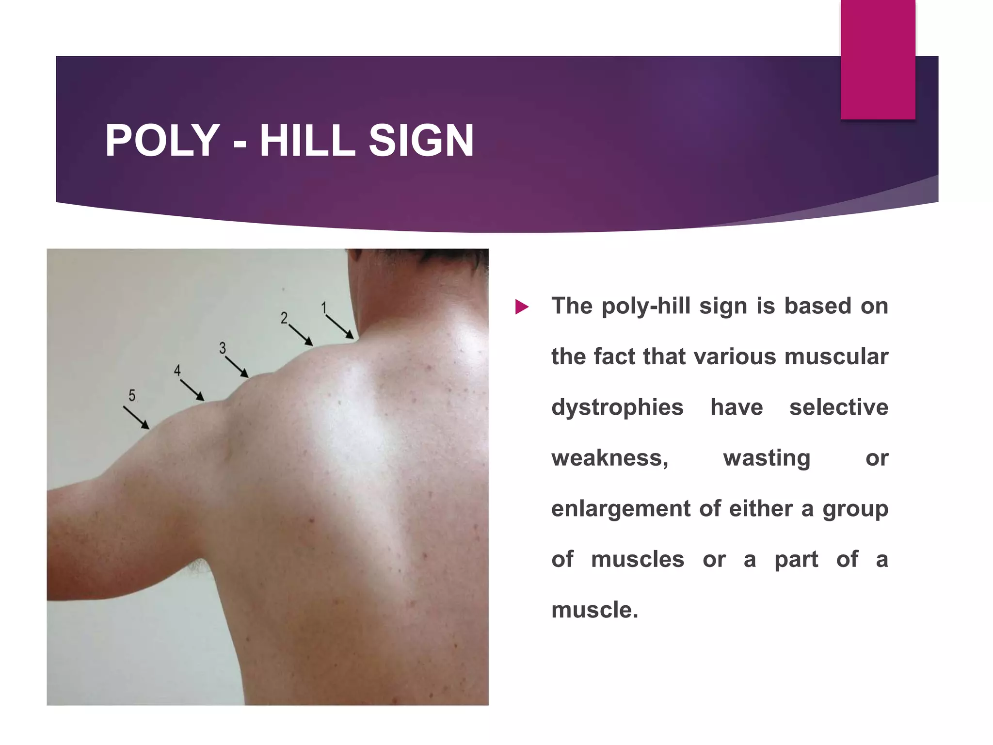 Muscular dystrophy | PPTX