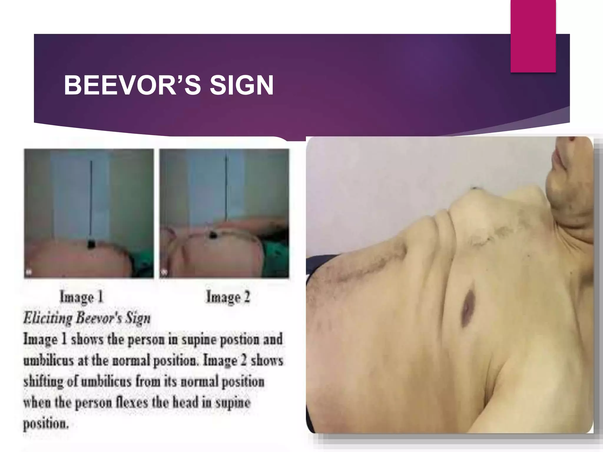 Muscular dystrophy | PPTX