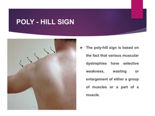 Muscular dystrophy | PPTX