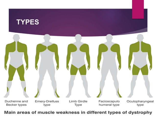 Muscular dystrophy | PPTX | Physical Therapy | Wellness