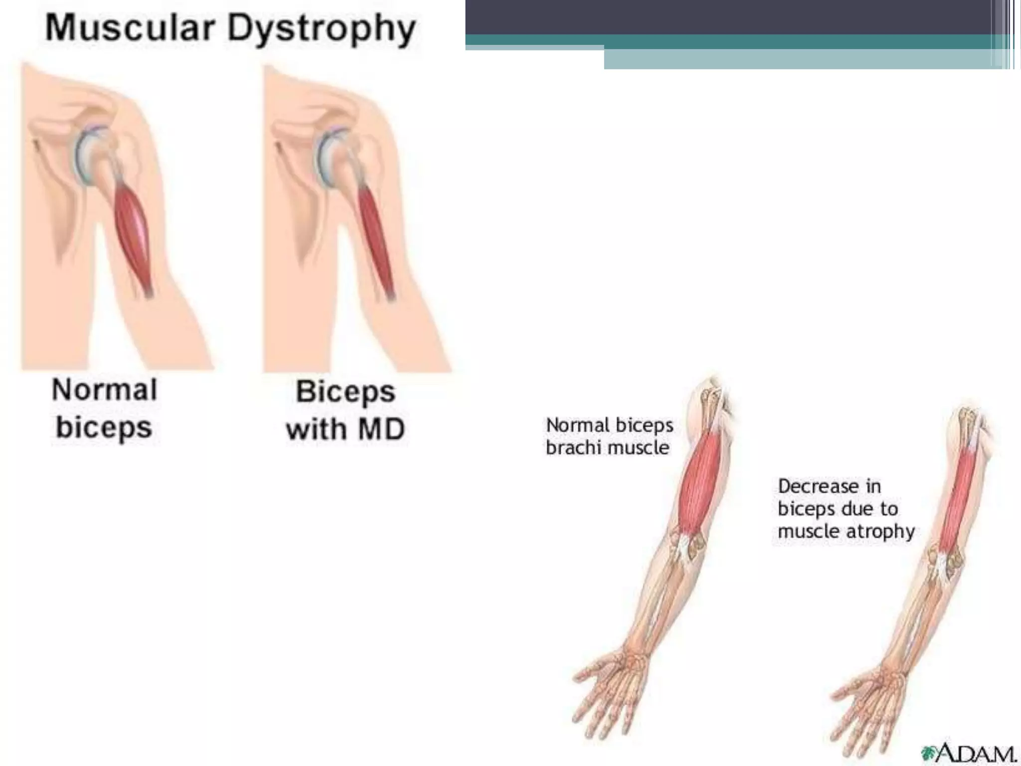 muscular dystrophy.pptx