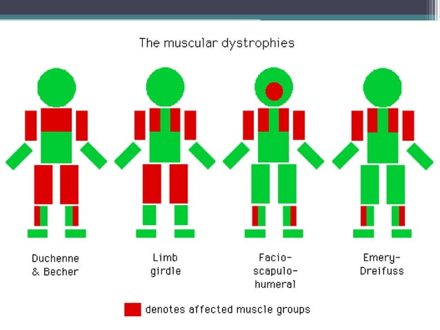 muscular dystrophy.pptx