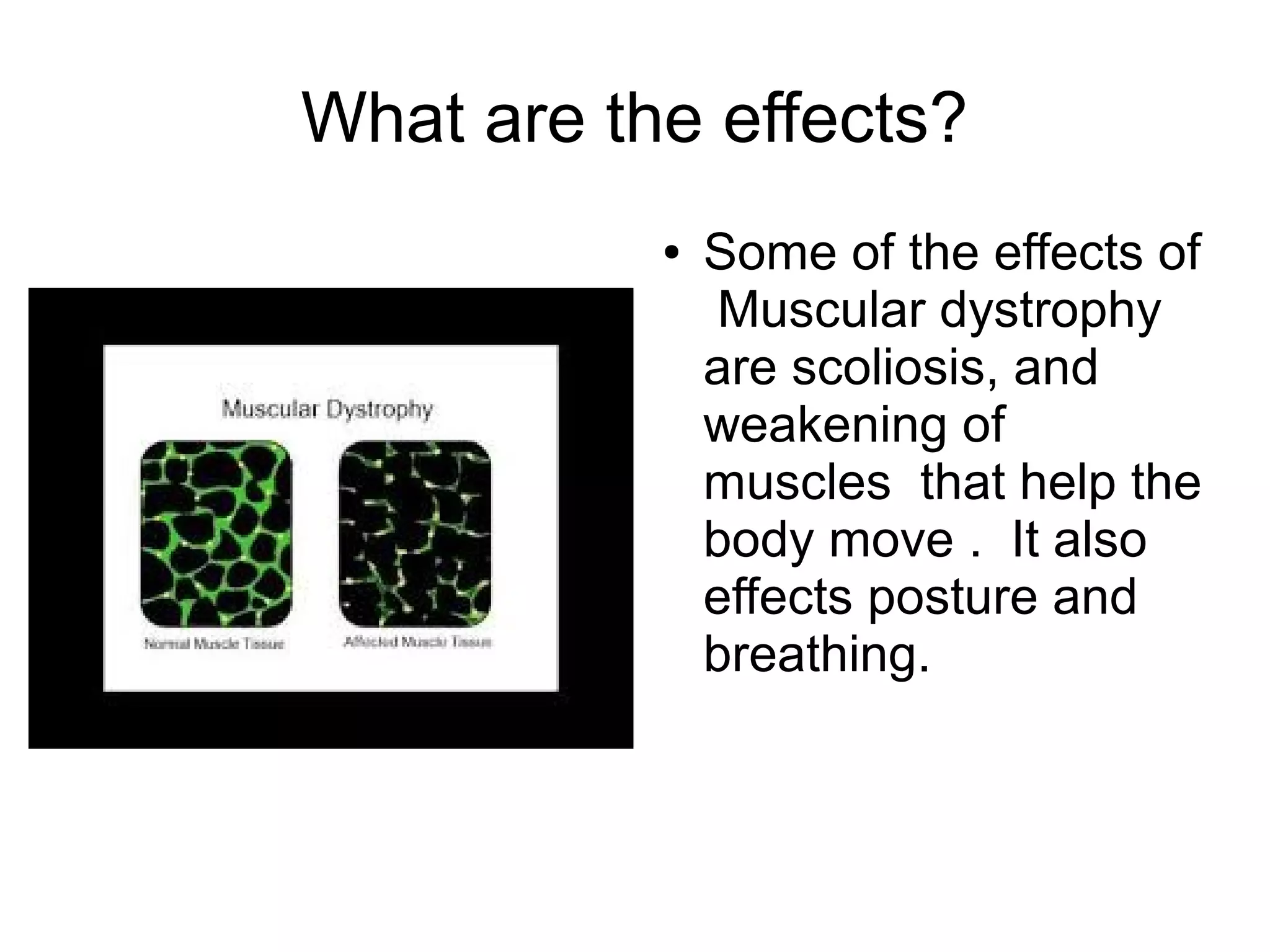 Muscular dystrophy ld | ODP