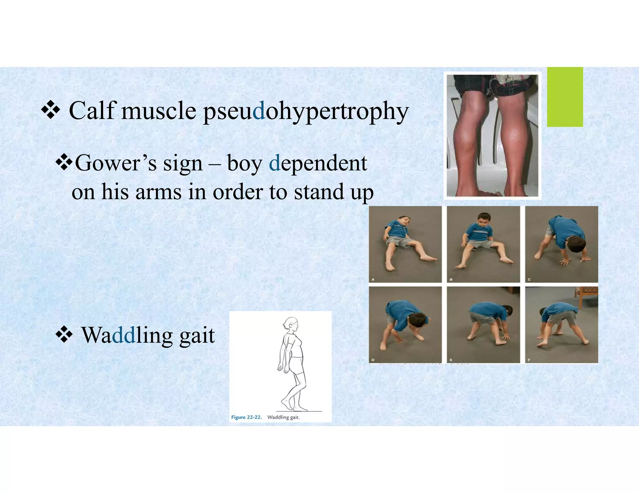 MUSCULAR DYSTROPHY PPT pdf | PDF