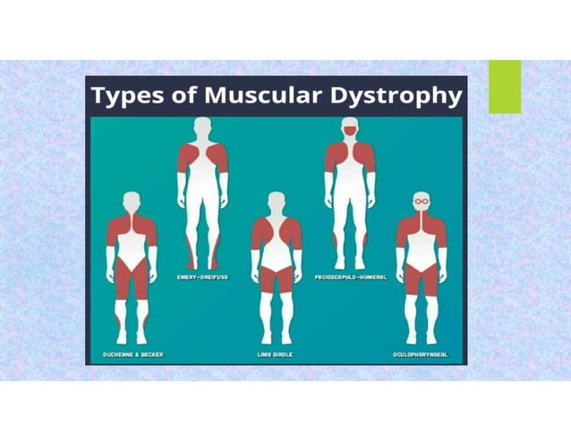 MUSCULAR DYSTROPHY PPT pdf | PDF