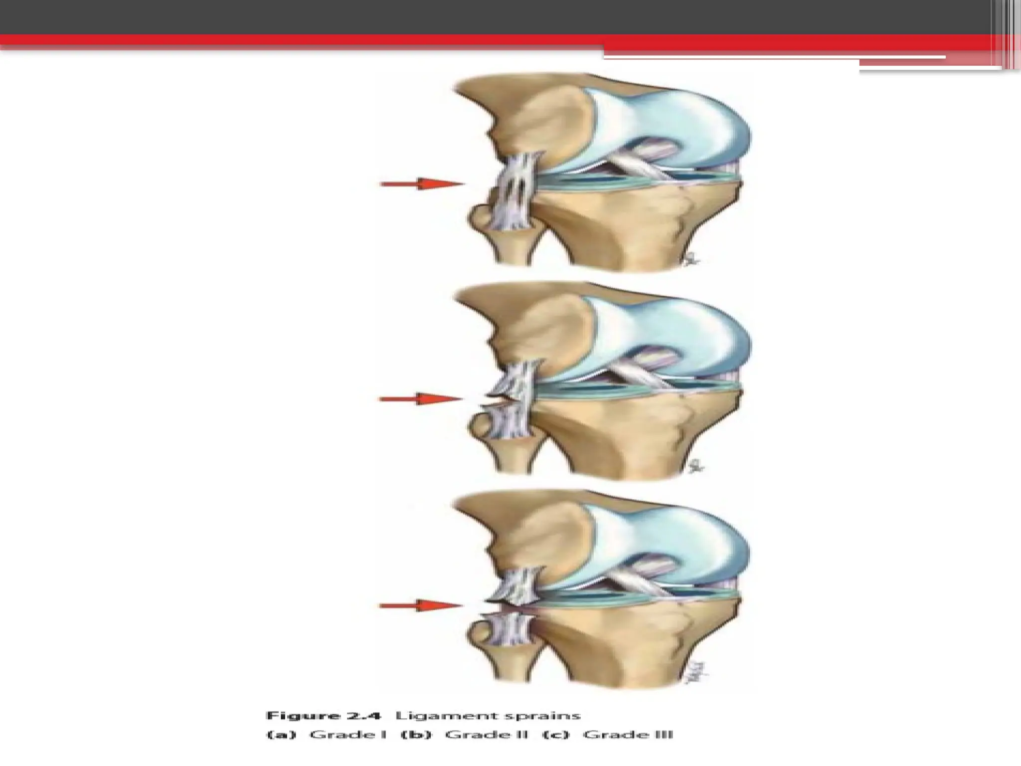muscular strain and contusion.pptx. . | PPTX
