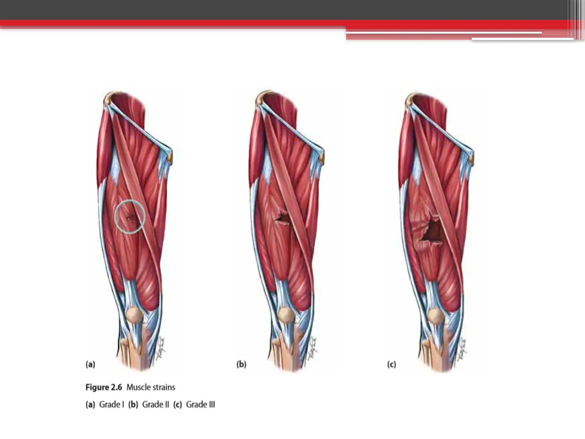 muscular strain and contusion.pptx. . | PPTX