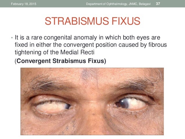 Musculofacial anomalies & Ocular Myopathies