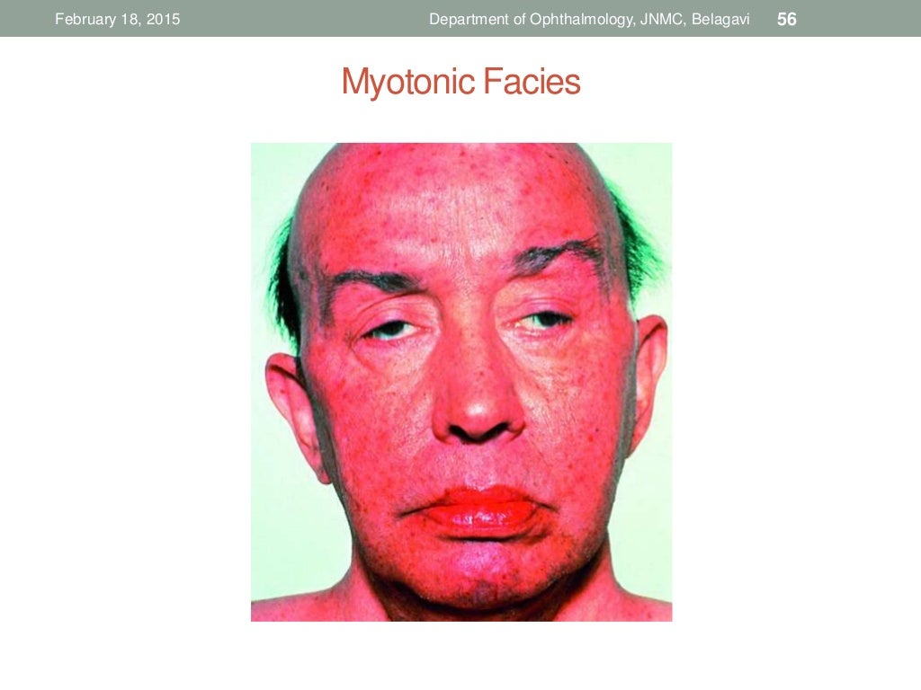 Musculofacial anomalies & Ocular Myopathies