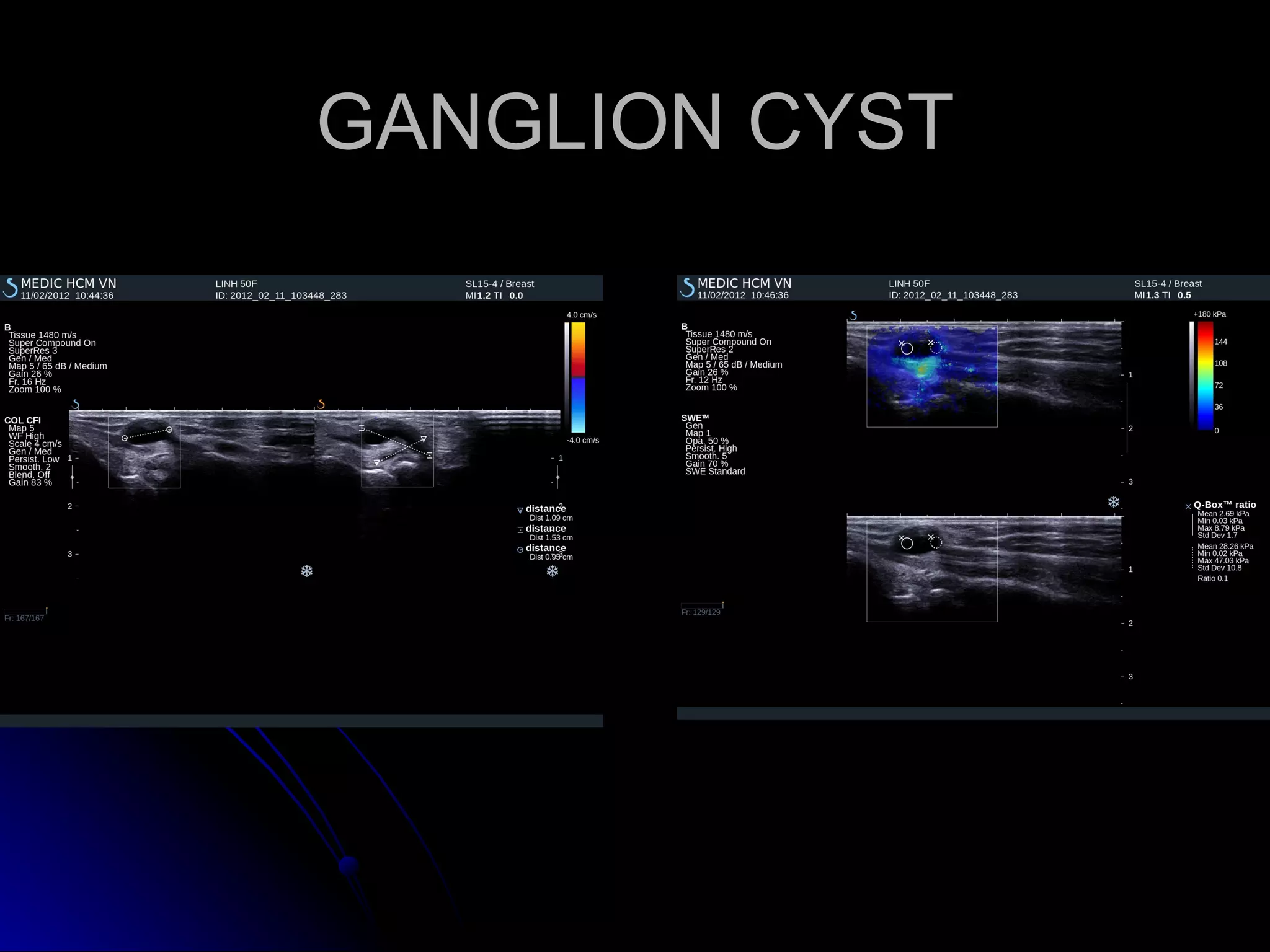 Musculoskeletal Applications of Supersonic Shear Imaging (SSI) | PPT ...